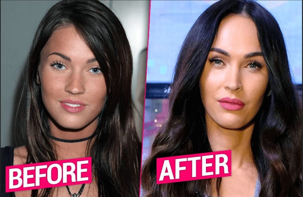 Is Megan Fox Secret in Cosmetic Surgery? - Verge Campus