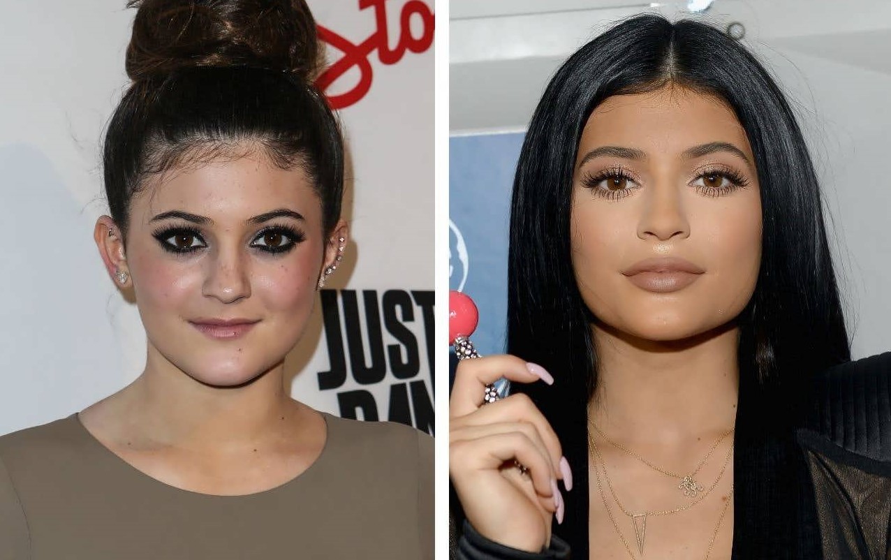 Kylie Jenner Body Before Plastic Surgery