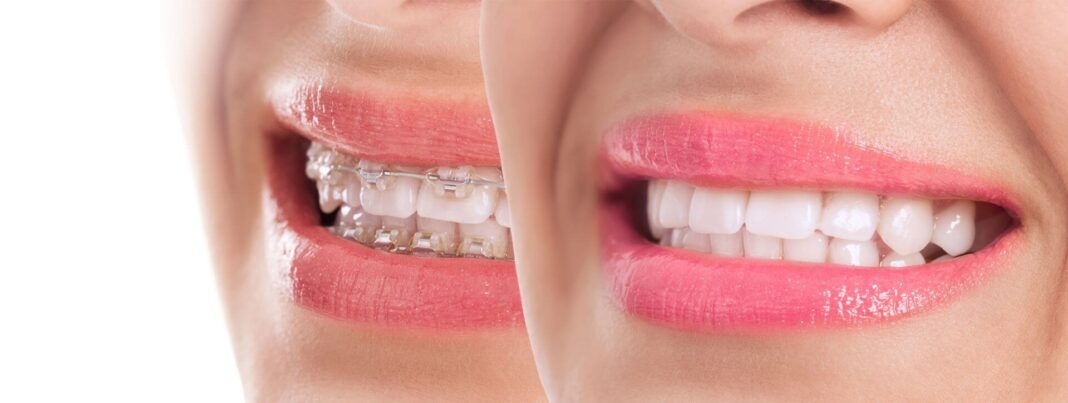 What Is The Difference Between Metal And Clear Braces Verge Campus