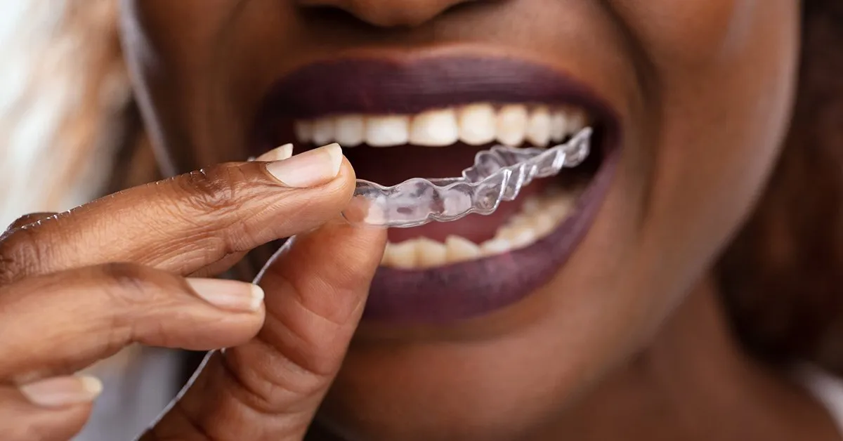 Your Path To A Perfect Smile: What To Expect With Invisalign Treatment ...